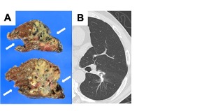 A robotic fissureless en bloc resection of left S6 and S1+2a+b for lung ...