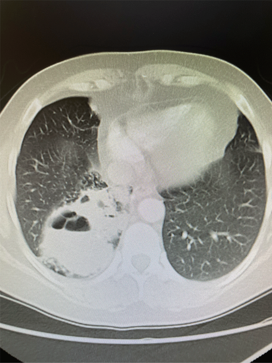 The role of 3-dimensional reconstruction imaging in bronchopulmonary ...