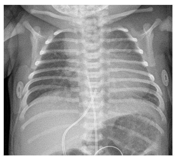 Truncus Arteriosus X Ray