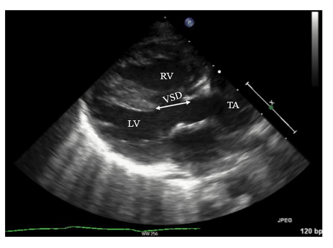 Truncus Arteriosus Echo