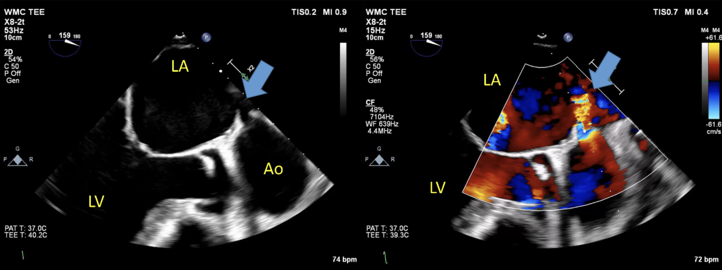 Redo partial aortic root remodelling in type A dissection with an aorto ...