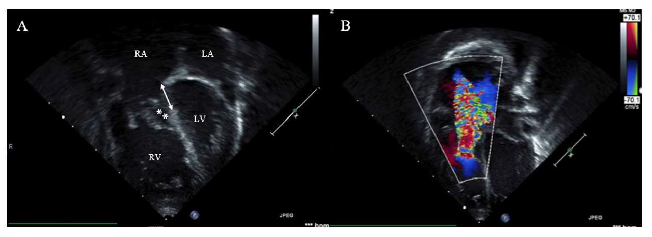 Modified Starnes procedure as a bridge to 2-ventricle repair in ...