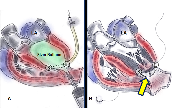 Endoventricular circular patch repair: the “Dor procedure” | MMCTS