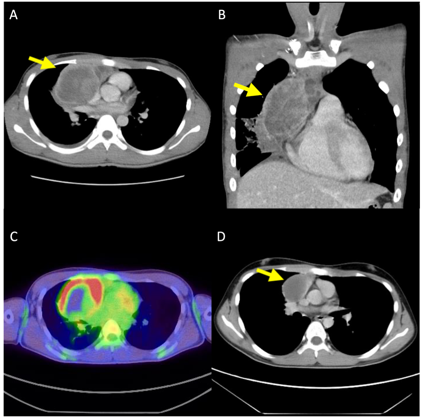 Subxiphoid robot-assisted complete resection for postchemotherapy ...
