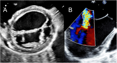 Three-dimensional, totally endoscopic mitral valve repair of anomalous ...