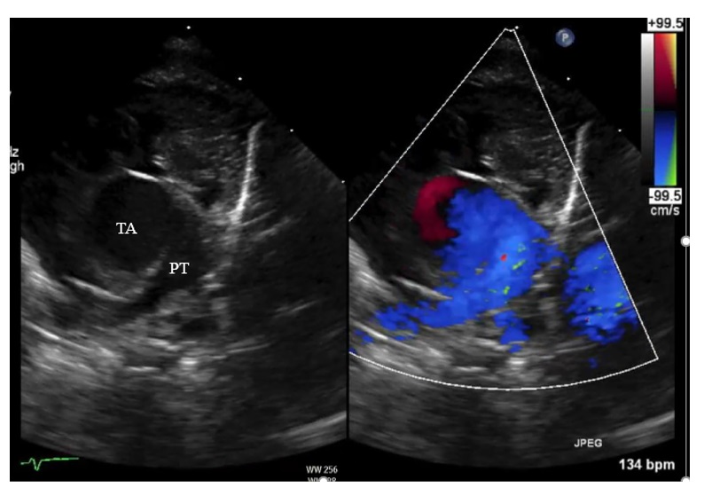 Modified Barbero-Marcial repair for type I truncus arteriosus in a 2.7 ...