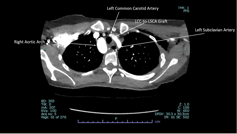 Single-incision, off-pump repair of a right aortic arch with an ...