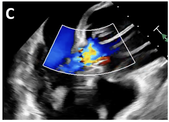 Bio-Bentall and hybrid arch frozen elephant trunk repair for acute type ...