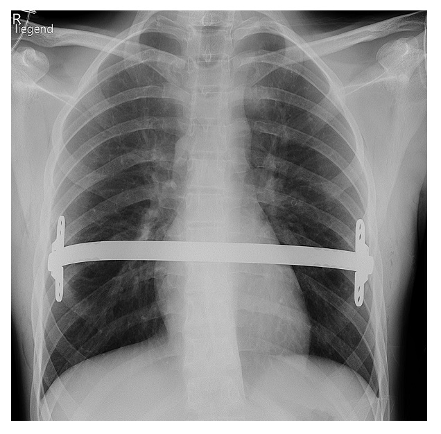 Pectus Carinatum X Ray