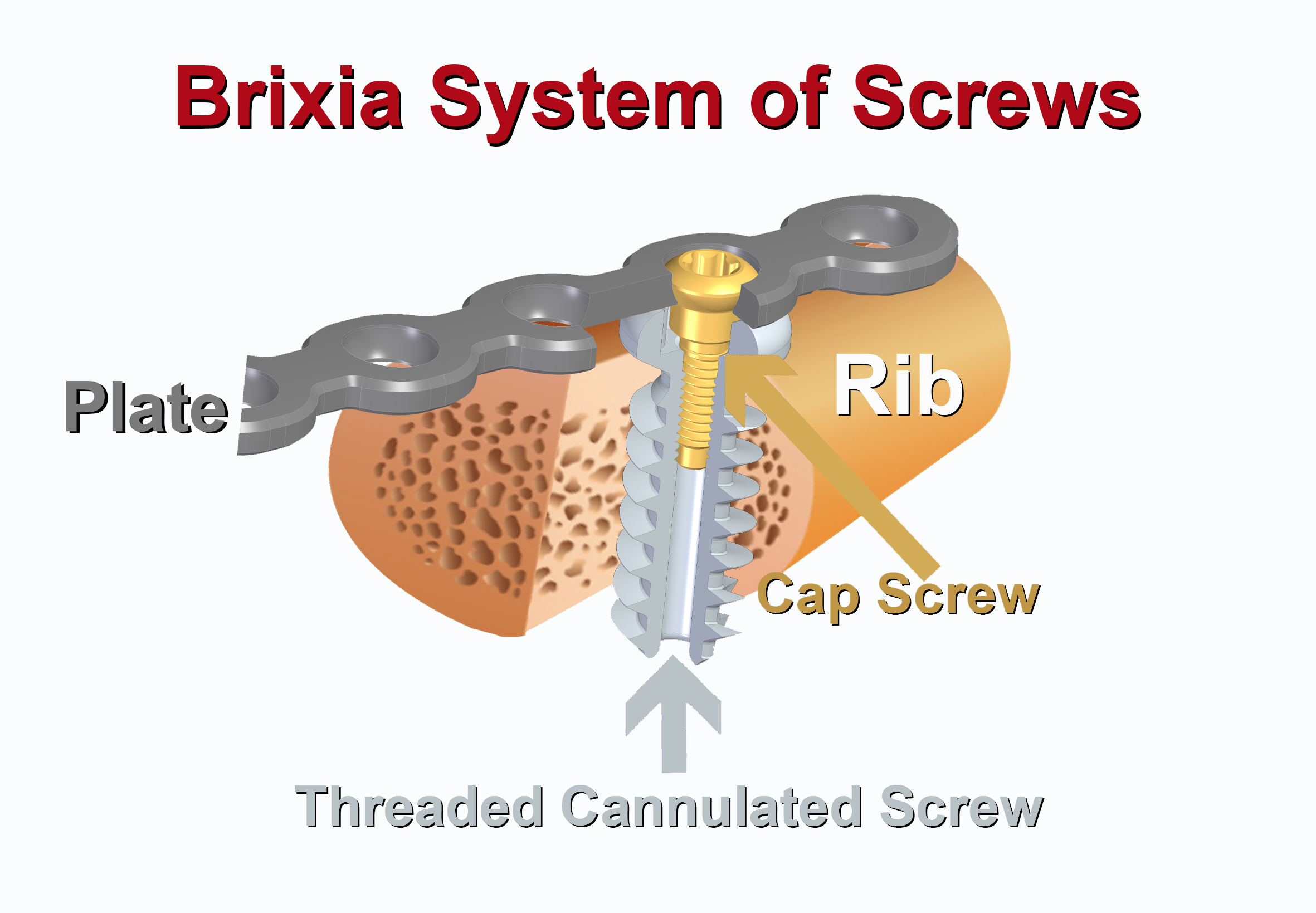Brixia system of screws: a titanium modular system with wide ...