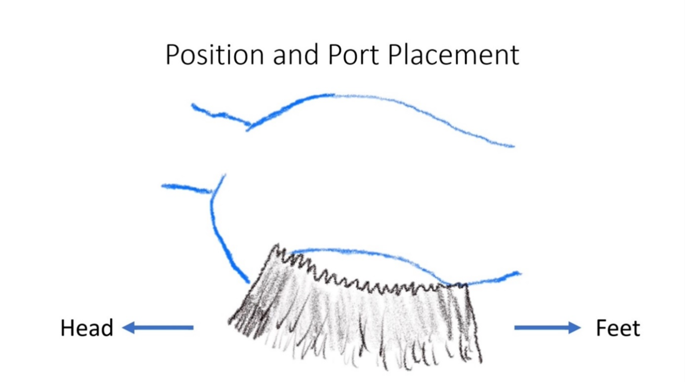 Robotic endoscopic transmitral septal myectomy and concomitant mitral ...