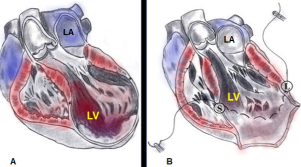 Endoventricular circular patch repair: the “Dor procedure” | MMCTS