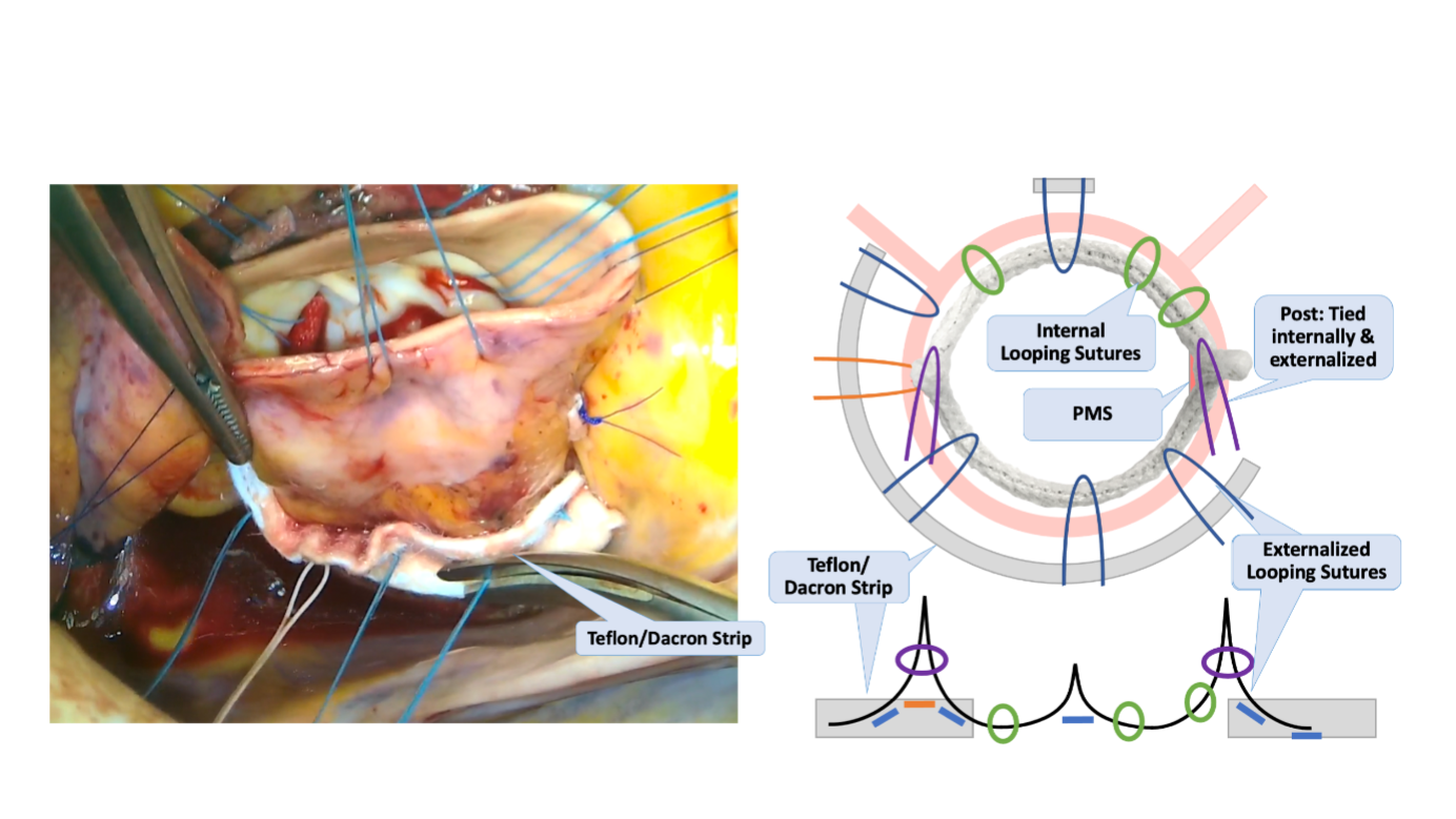 Functional aortic annulus 3-dimensional remodelling during bicuspid aortic valve repair ...