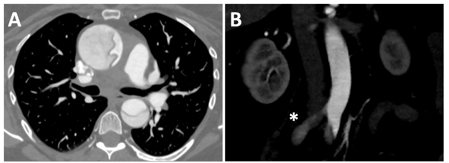 Bio-Bentall and hybrid arch frozen elephant trunk repair for acute type ...