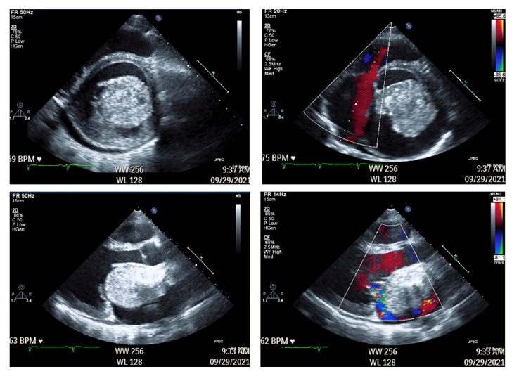 Resection of a large left atrial myxoma combined with mitral valve ...
