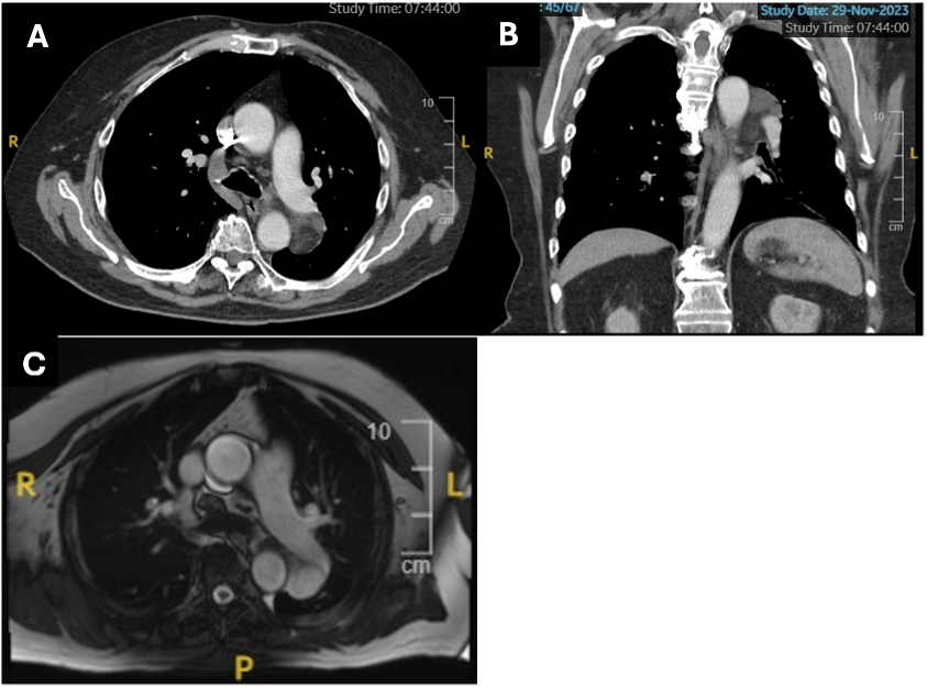 Robotic resection of a mediastinal liposarcoma | MMCTS