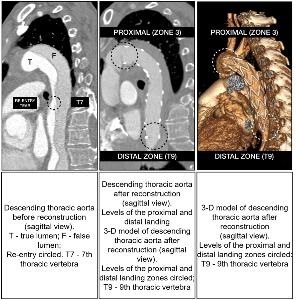 Aortic valve resuspension using the Florida sleeve technique with ...