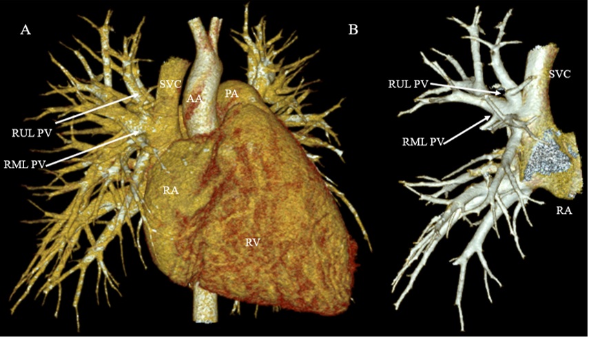 Vertical right axillary thoracotomy for a modified Warden procedure ...