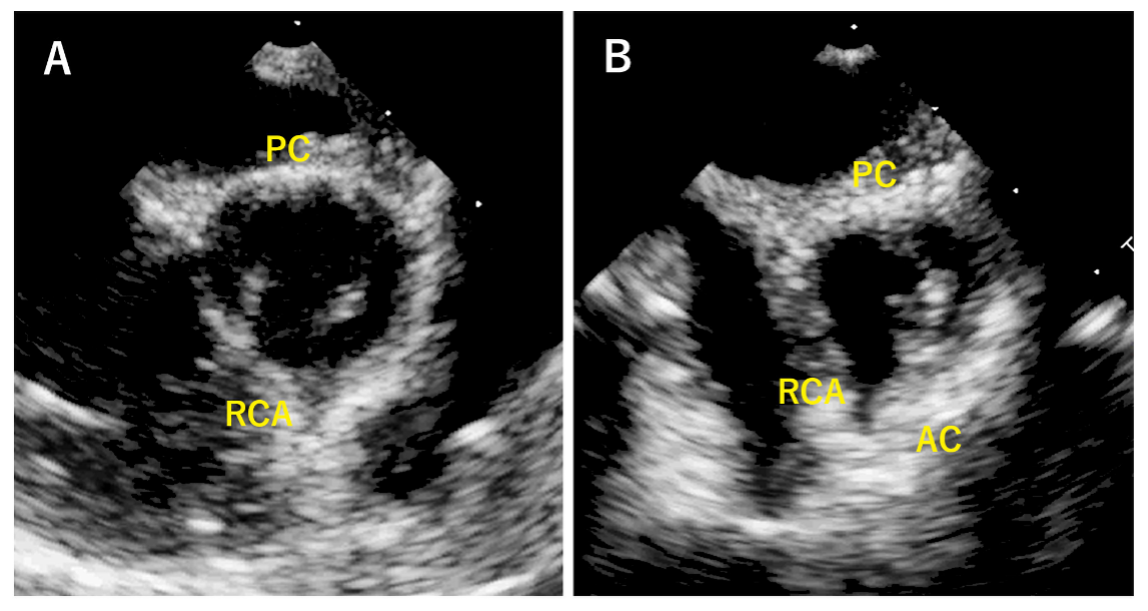 Coronary orifice rotation for symmetric bicuspidization of a paediatric ...