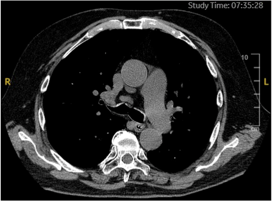 Robotic resection of a mediastinal liposarcoma | MMCTS