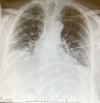 Segmentectomies Made Easy Series: robotic-assisted left S8 ...