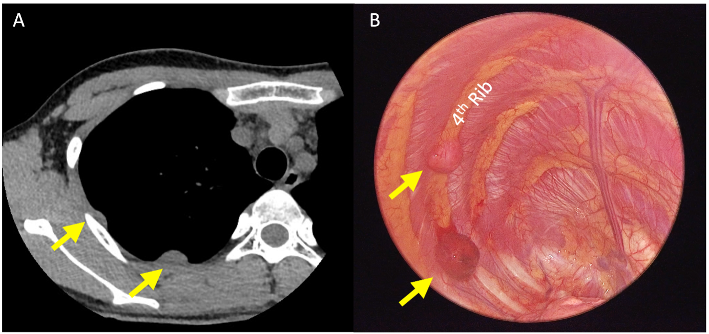 Subxiphoid robot-assisted complete resection for postchemotherapy ...