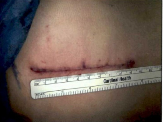 Vertical right axillary thoracotomy for a modified Warden procedure ...