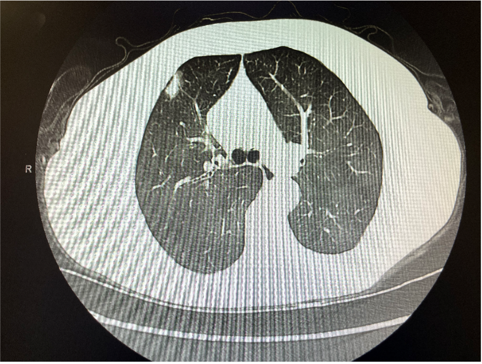 Video atlas of pulmonary segmentectomy: robotic-assisted right S3 ...