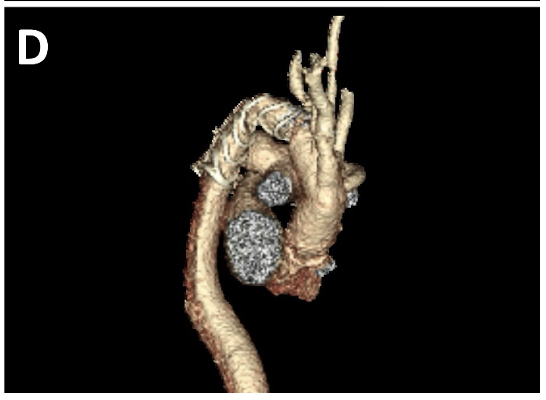 Bio-Bentall and hybrid arch frozen elephant trunk repair for acute type ...