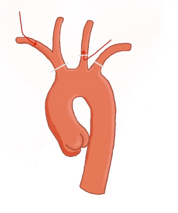 Ascending aortic and proximal hemiarch replacement with antegrade ...