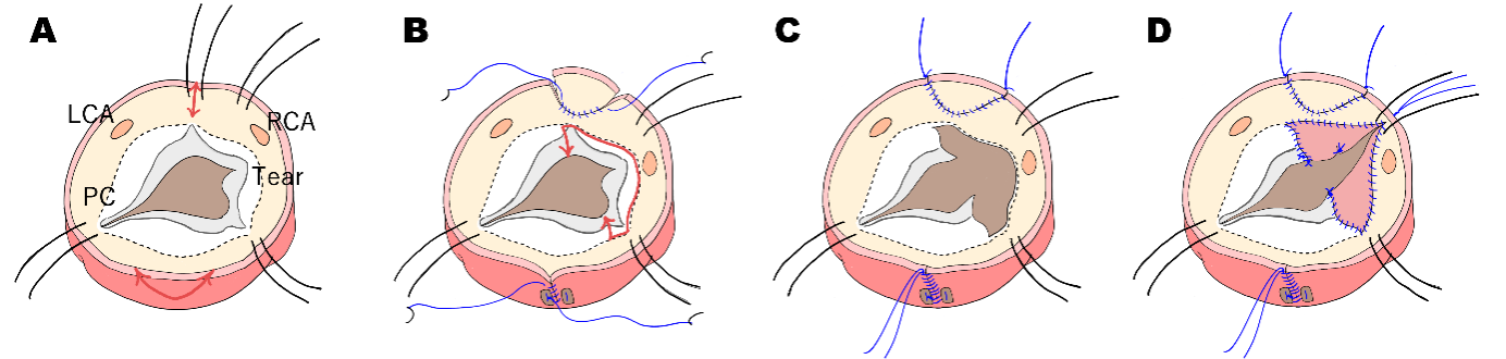 Coronary orifice rotation for symmetric bicuspidization of a paediatric ...