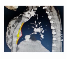Video-assisted thoracoscopic surgery repair of an idiopathic internal ...