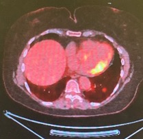 Segmentectomies Made Easy Series: robotic-assisted left S8 ...
