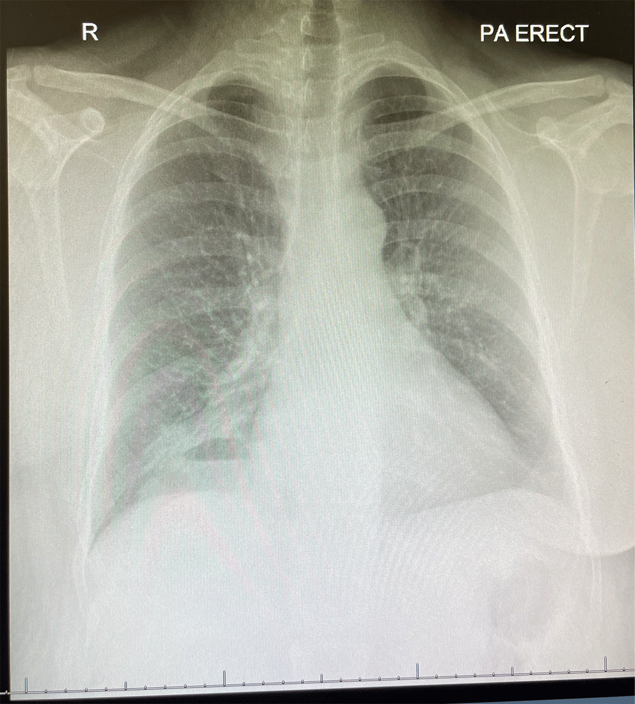 The role of 3-dimensional reconstruction imaging in bronchopulmonary ...