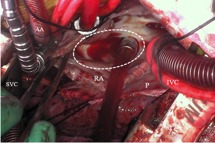 Vertical right axillary thoracotomy for a modified Warden procedure ...