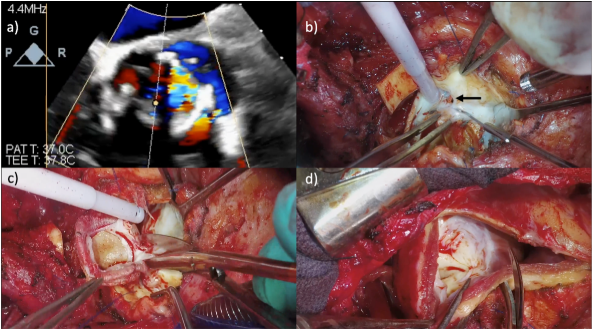 The Ross procedure for recurrently failed aortic valve procedures | MMCTS