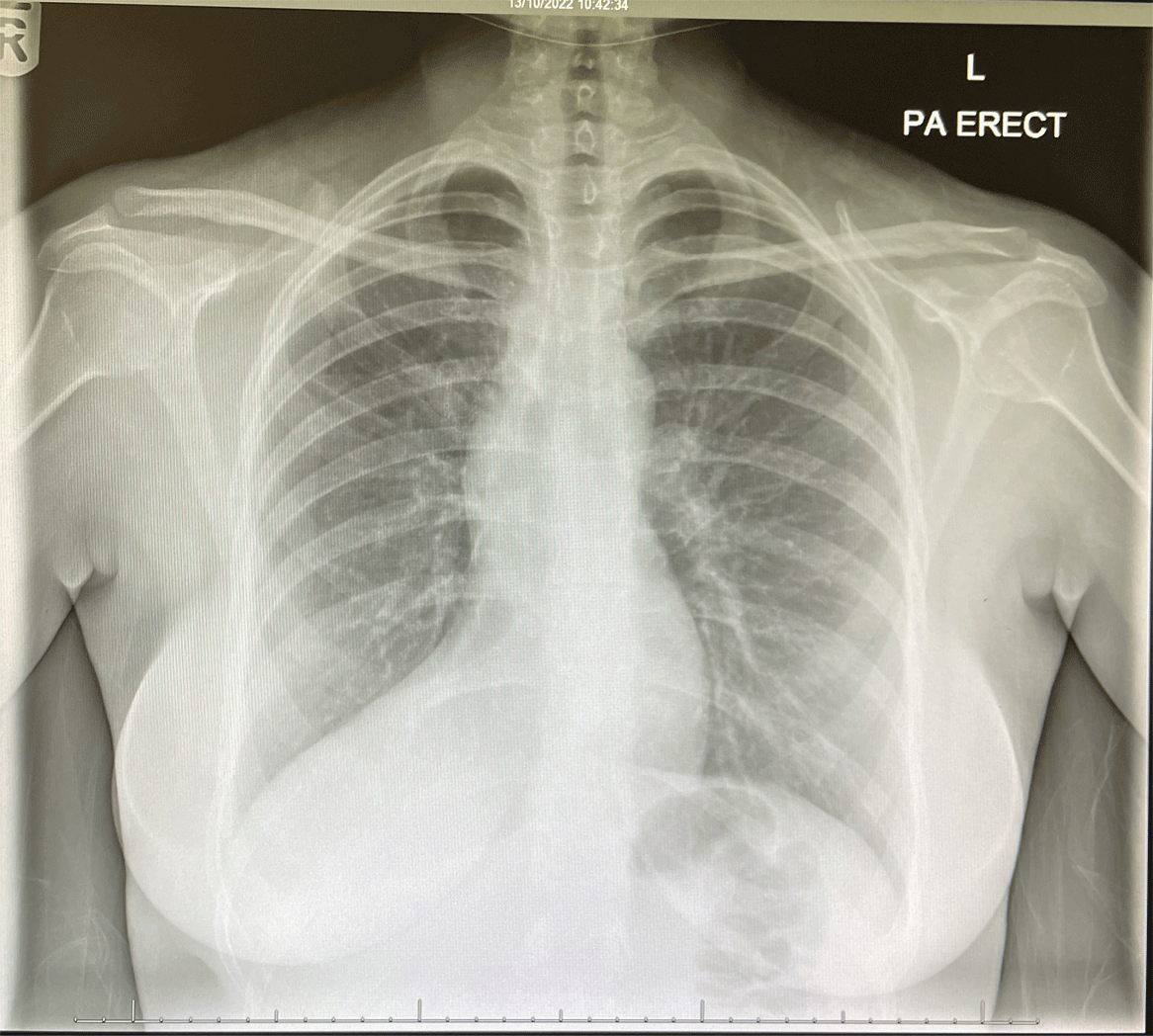 The role of 3-dimensional reconstruction imaging in bronchopulmonary ...