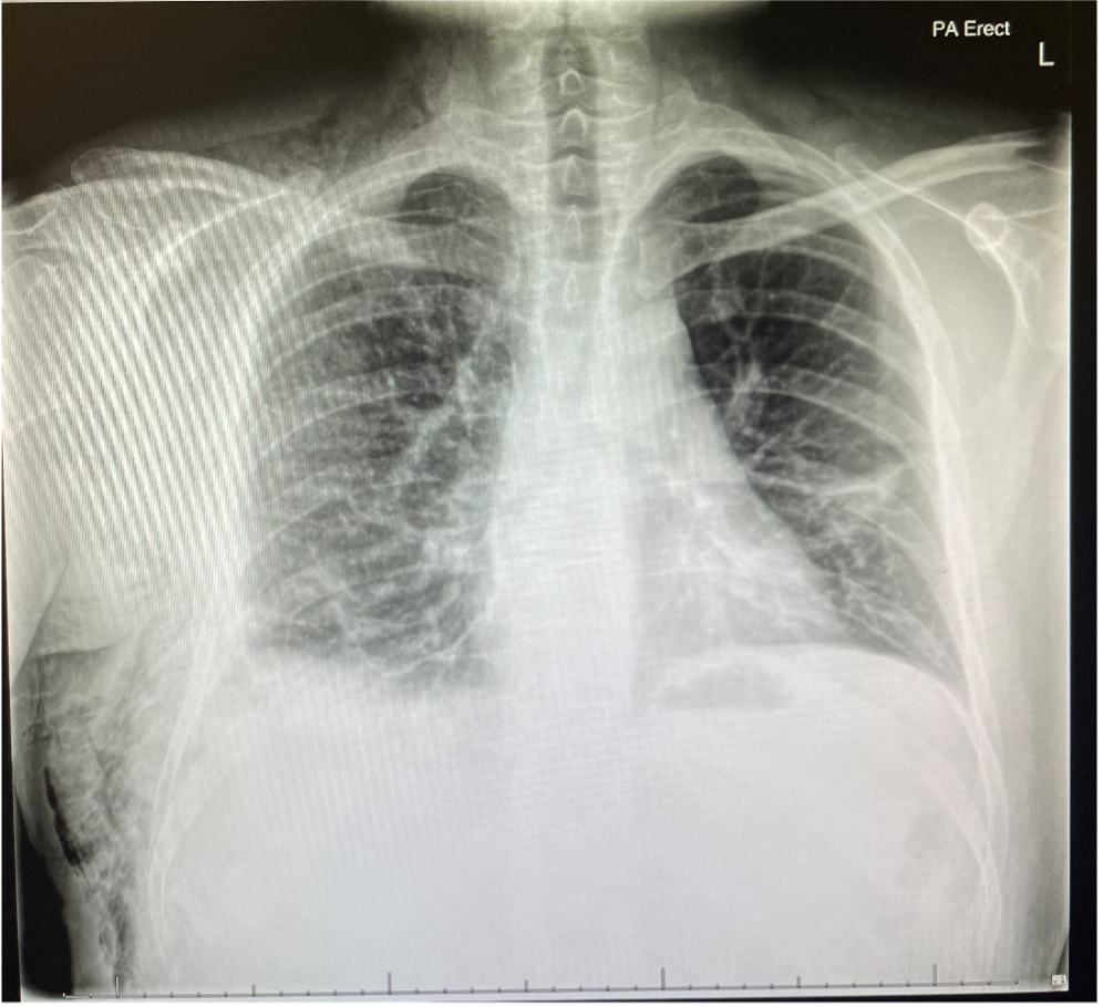 Robotic-assisted carinal reconstruction using cross-table ventilation ...