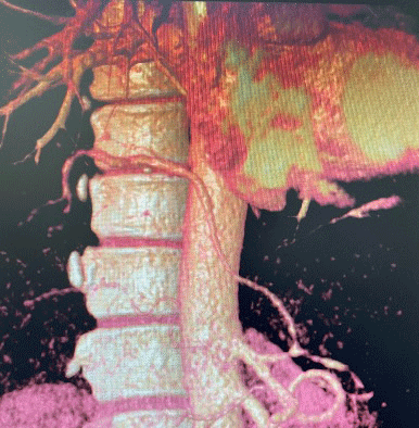 The role of 3-dimensional reconstruction imaging in bronchopulmonary ...