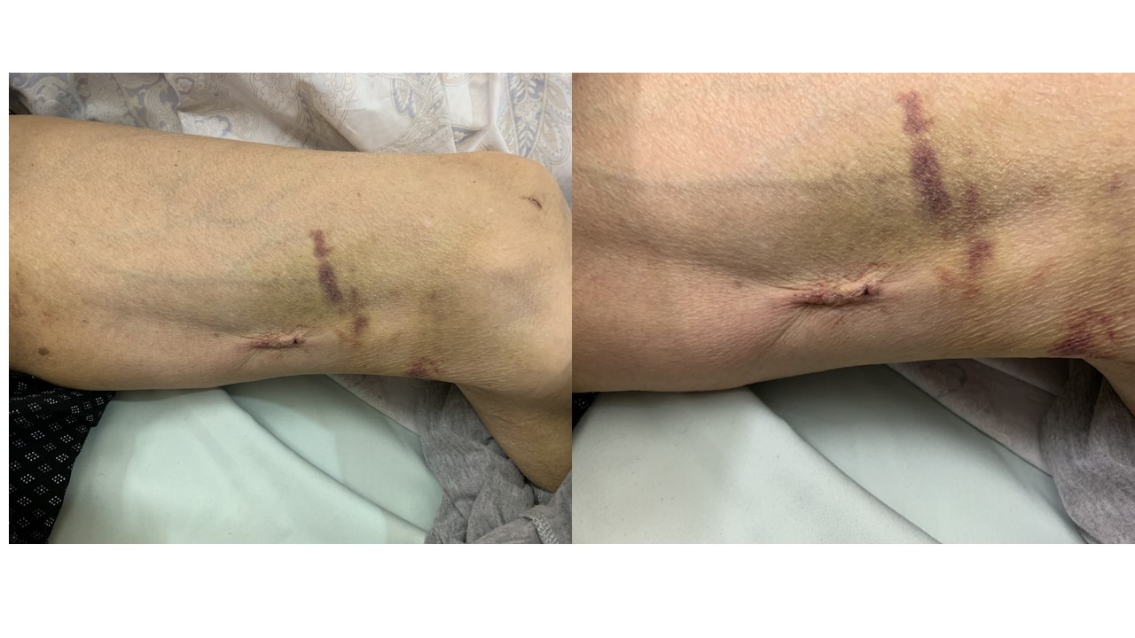 The endoscopic no-touch saphenous vein harvesting technique | MMCTS
