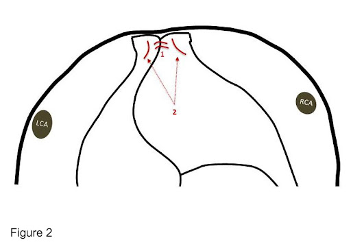 Pediatric aortic valve neocuspidization | MMCTS