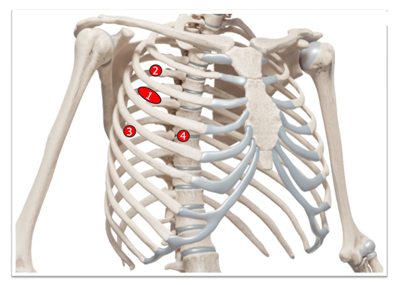 Redo totally endoscopic, robotic-assisted correction of previously ...
