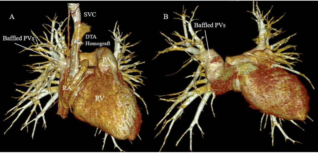 Vertical right axillary thoracotomy for a modified Warden procedure ...