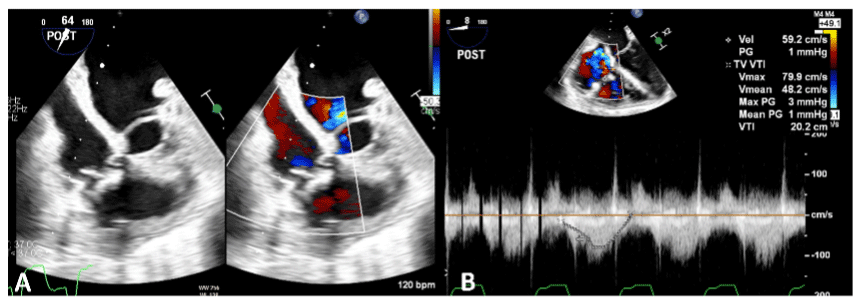 Edge-to-edge repair with ring annuloplasty for post-transplant biopsy ...