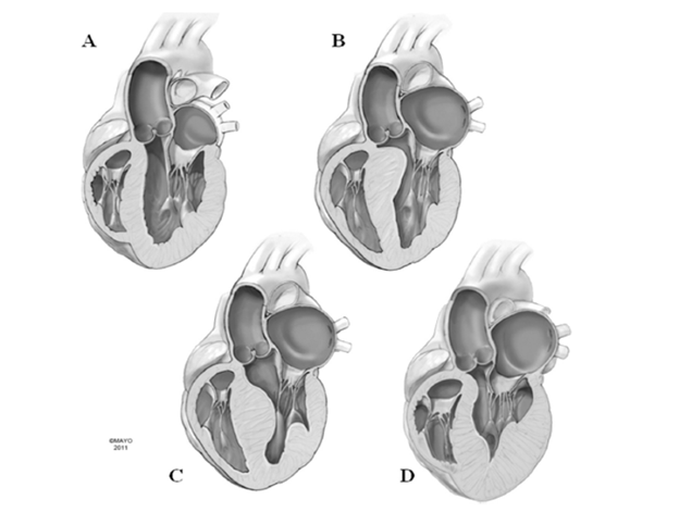 Transaortic extended left ventricular septal myectomy in an adult with ...