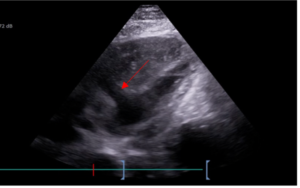 Transatrial repair of a ventricular septal defect and tricuspid valve ...