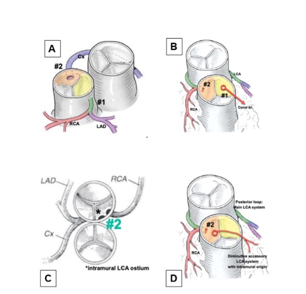 Coronary transfer for complex looping and intramural variants in the ...