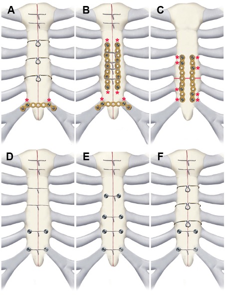Brixia system of screws: a titanium modular system with wide ...