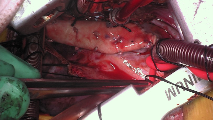 Vertical right axillary thoracotomy for a modified Warden procedure ...