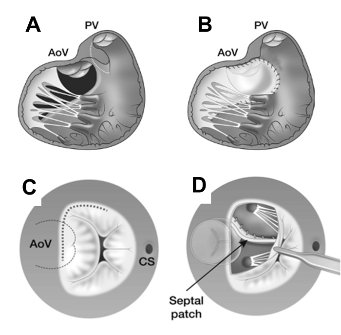 Two-patch transannular repair of tetralogy of Fallot with complete ...